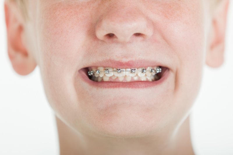 Do You Need Your Wisdom Teeth Removed Before Getting Braces
